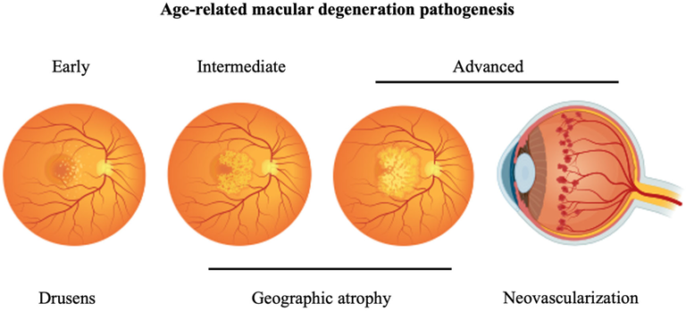 Understanding Macular Degeneration and Its Impact on Vision - AKIO